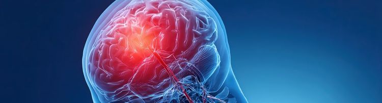 Acidente vascular cerebral isquêmico : sintomas e causas