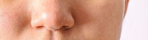 Câncer de pele no nariz: como identificar